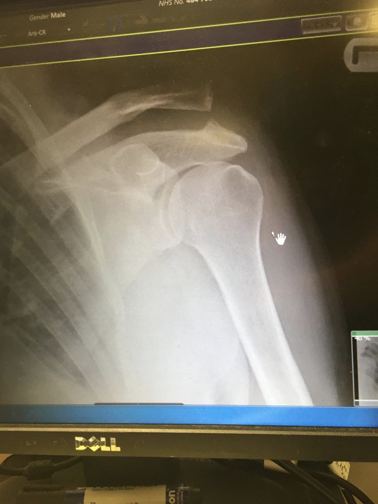 Ian’s dislocated collar bone! | Torbay and Teign Chiropractic